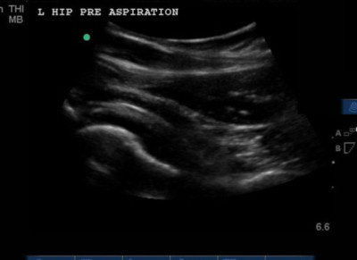 Ultrasound Guided Hip Injections | Advanced Hip Imaging | Nashville, TN